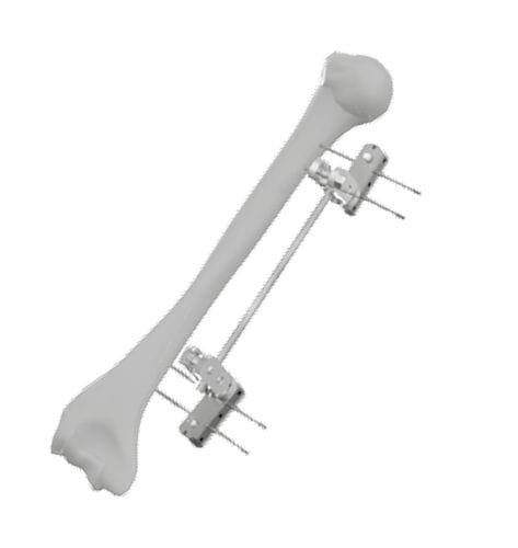 Humerus external fixation system - 201541 - SOFEMED International ...