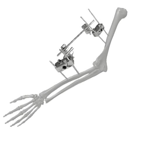 Elbow external fixation system - 206303 - SOFEMED International ...