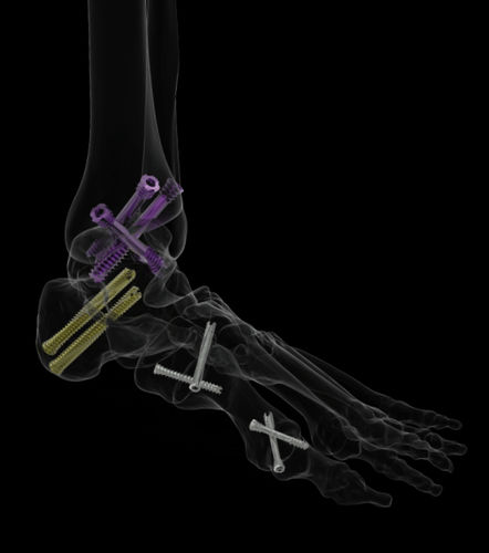 Foot compression bone screw - H1.4QT4.0Lxx - Newclip Technics - humerus ...