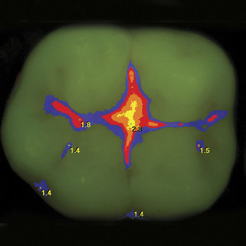 Laser Fluorescence Caries Detector Camx Spectra Air CamX Spectra