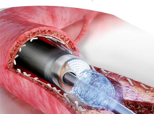 Laser atherectomy catheter - Turbo-Power™ - Spectranetics - peripheral