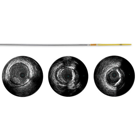 Ultrasound catheter - Refinity - Philips Volcano - coronary / hydrophilic