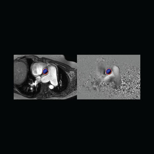 Angiography software - CAAS MR Flow - Pie Medical Imaging - clinical ...
