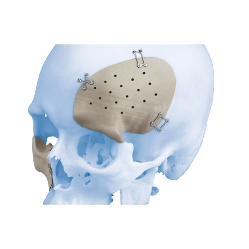Custom-made cranial implant - Depuy Synthes