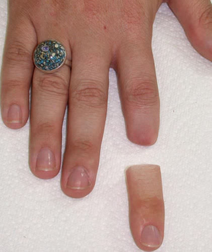 Finger cosmetic prosthesis - Aesthetic Prosthetics - adult