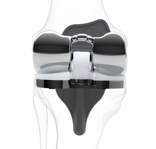Total knee prosthesis - iTotal PS - ConforMIS - sliding, posterior ...