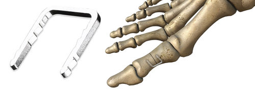 Forefoot bone staple - CHARLOTTE™ - Wright Medical Technology - non ...