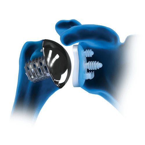 Cemented or non-cemented shoulder prosthesis - Eclipse™ - Arthrex