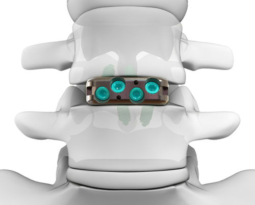 Lumbar interbody fusion cage - DYNA-LINK® ELITE - Life Spine - anterior