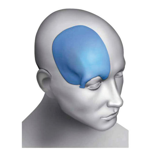 Custom-made cranial implant - Matrix Omnipore® - Acumed