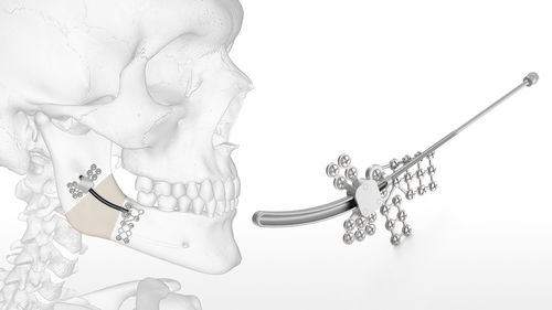Mandibular distractor - Logic ™ - Acumed - internal / adult