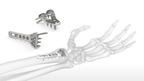 Radius compression plate - ExtremiLock™ - Acumed - wrist / distal / locking