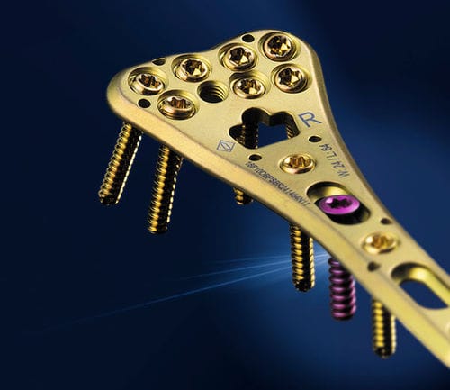 Radius compression plate - SIGNEX - OSTEONIC - distal / locking / metallic