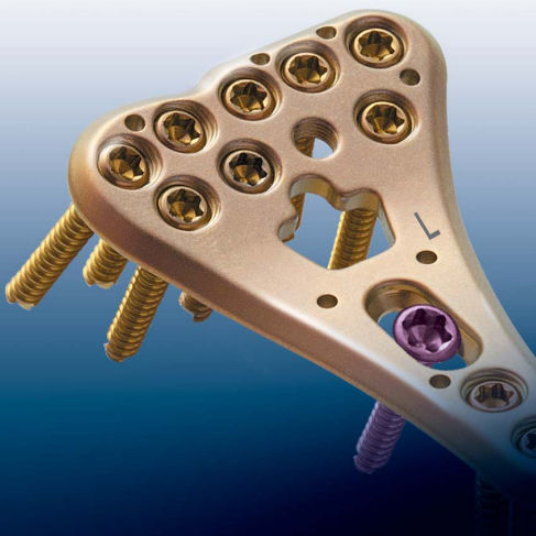 Radius compression plate - OSTEONIC - distal / locking / metallic