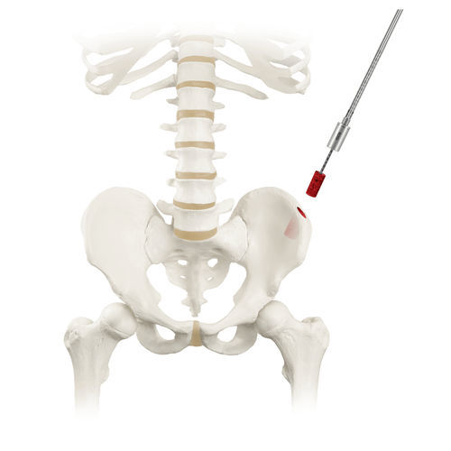 Bone marrow biopsy needle - RETRIEVE® - Globus Medical