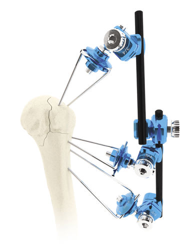 Humerus external fixation system - CLICKIT - MIKAI - tubular / adult