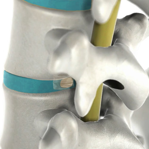 Lumbar disc prosthesis - NEOS Surgery