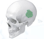 Cranial fixation system - All medical device manufacturers