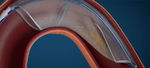 Embolic protection system - All medical device manufacturers