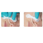 Adhesive catheter fixation - All medical device manufacturers