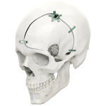 Cranial fixation system - All medical device manufacturers