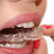 Dental aligner - Smilers - BIOTECH DENTAL
