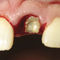 Tapered dental implant - Hahn™ - Glidewell Europe - titanium / internal ...