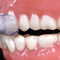 Bruxism mouthguard - NTI-tss Plus® - Glidewell Europe