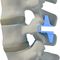Lumbar interspinous vertebral implant - coflex® - RTI Surgical