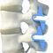 Lumbar interspinous vertebral implant - coflex® - RTI Surgical