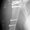 Humeral intramedullary nail - CarboFix Orthopedics - proximal fixation ...