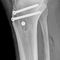Tibial intramedullary nail - CarboFix Orthopedics - proximal fixation ...