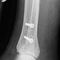 Tibial intramedullary nail - CarboFix Orthopedics - proximal fixation ...