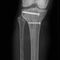 Tibial intramedullary nail - CarboFix Orthopedics - proximal fixation ...