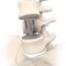 Thoraco-lumbar vertebral corpectomy prosthesis - POSEIDON - Signus ...