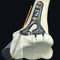 Radius compression plate - GEMINUS ® - Skeletal Dynamics - distal ...
