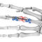 Metacarpophalangeal joint external fixation system - FIXUS22 - Fixus ...