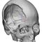 Custom-made cranial implant - OP89020 - Matrix Surgical USA