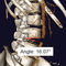 Orthopedic software - mediCAD Hectec GmbH - planning / spine / 3D