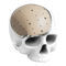 Custom-made cranial implant - PEEK3D - Kontour Medical Technology