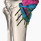 Tibial osteotomy resection guide - 3D Side
