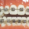 Metal orthodontic bracket - Synergy FX® - Rocky Mountain Orthodontics ...