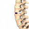 Lumbar disc prosthesis - Ti-6Al-4V ELI - Aditus Medical