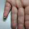 Finger cosmetic prosthesis - Medical Art Prosthetics - partial / adult