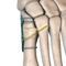 Hallux valgus osteotomy plate - dynaBunion® - CrossRoads Extremity Systems