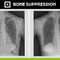 Medical software - Bone Suppression - Digitec - radiography / diagnostic / post-processing