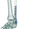 Fibula compression plate - TRUE LOCK Distal Fibula - Truemed Medical ...