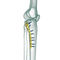 Tibia compression plate - TRUE LOCK Proximal Tibia Posteromedial ...