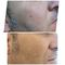 Plasma skin rejuvenation unit - Plexr Plus - GMV Medical Innovation
