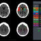 Medical software - ASPECTS - RapidAI - clinical / CT / for stroke diagnosis